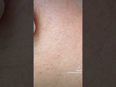 Electrolysis hair removal