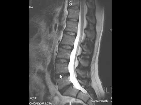 How to Read an MRI Scan of the Lumbar Spine | First Look MRI