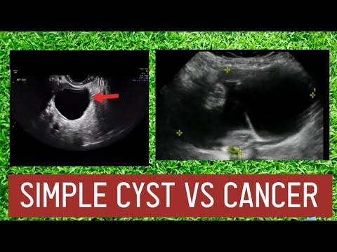 7differences between ovarian cyst & cancer in urdu | ovary cyst can turn into cancer | ovarian tumor