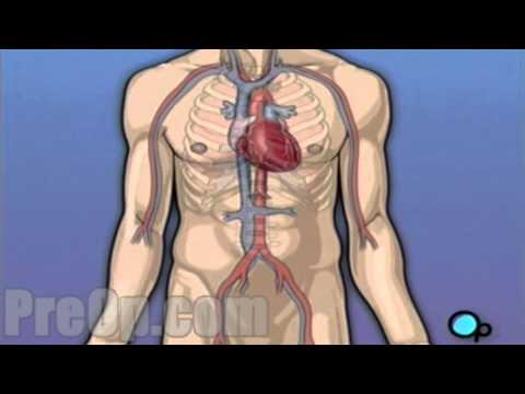 Coronary Artery Bypass Graft (CABG) Heart Surgery PreOp® Patient Education Medical video