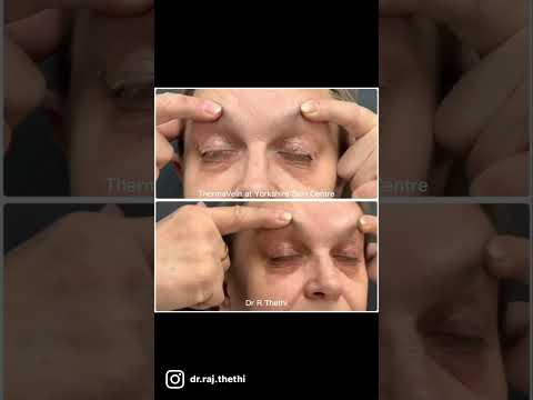 Removal of 45 skin tags on a patient’s eye lids using ThermaVein