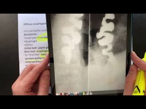 Diffuse Esophageal Spasm. USMLE review.