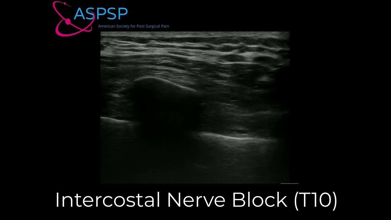 Intercostal Nerve Block for Shingles Pain