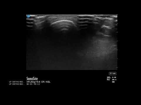 Toe Ultrasound: Proximal Phalanx Fracture