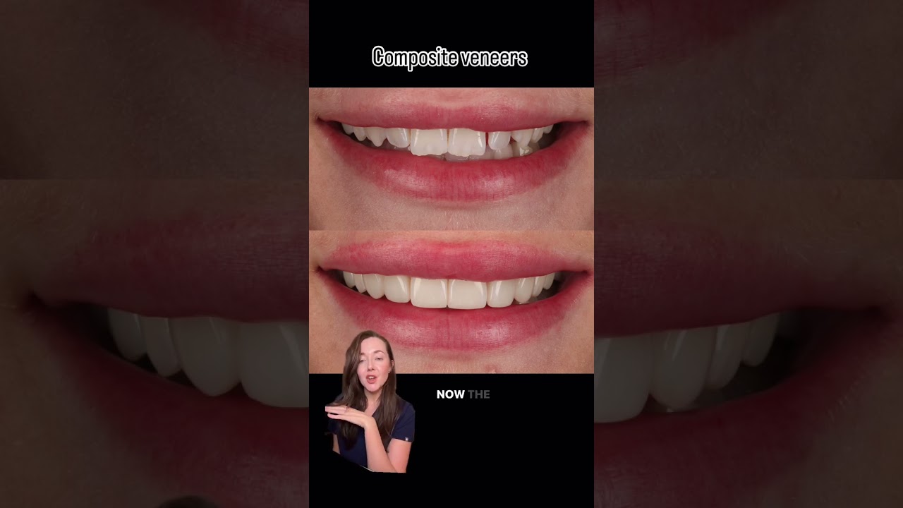 Composite Bonding Case Study With Dr. Rebecca Masterson