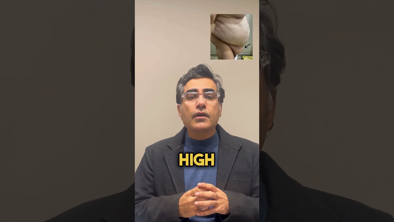 Panniculectomy Surgery : What You Need to Know? Panniculectomy Surgery in Delhi NCR India
