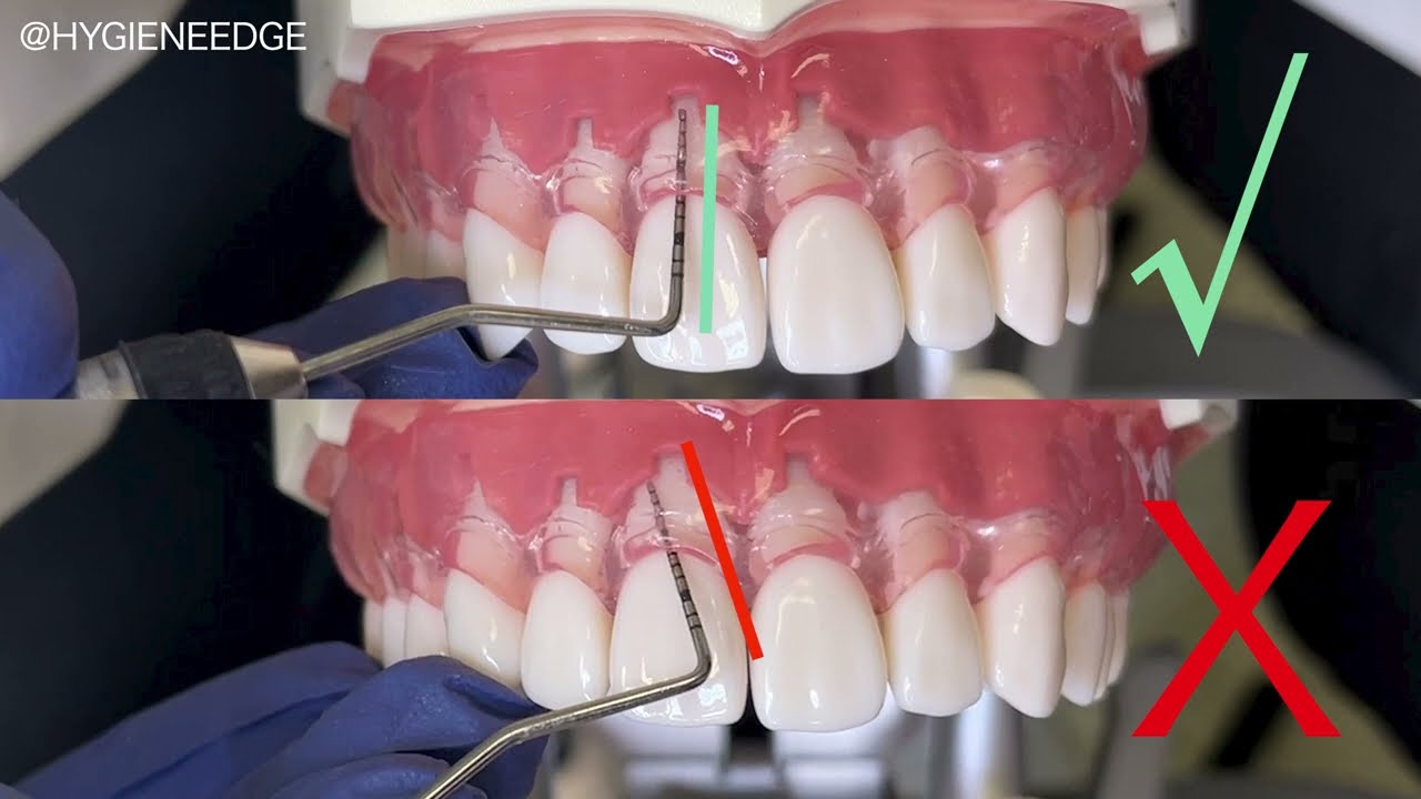All Things Periodontal Probing with Kilgore International