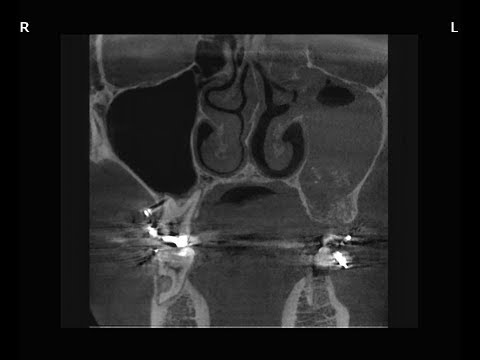 Maxillary Sinus Perforation Treatment