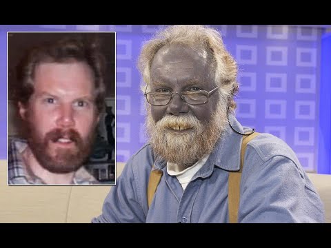 BLUE MAN SYNDROME (Argyria)