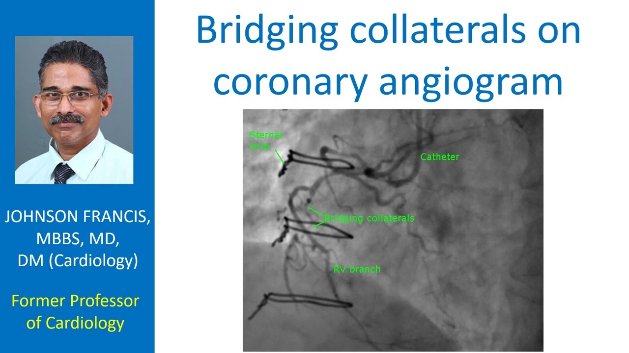 Bridging collaterals on coronary angiogram