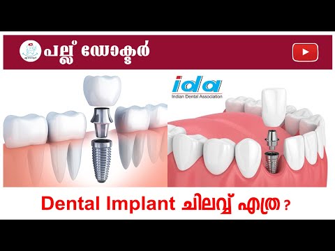 Dental Implant ചിലവ് എത്ര? l "Navigating Dental Implant Costs: Understanding Expenses and Options"