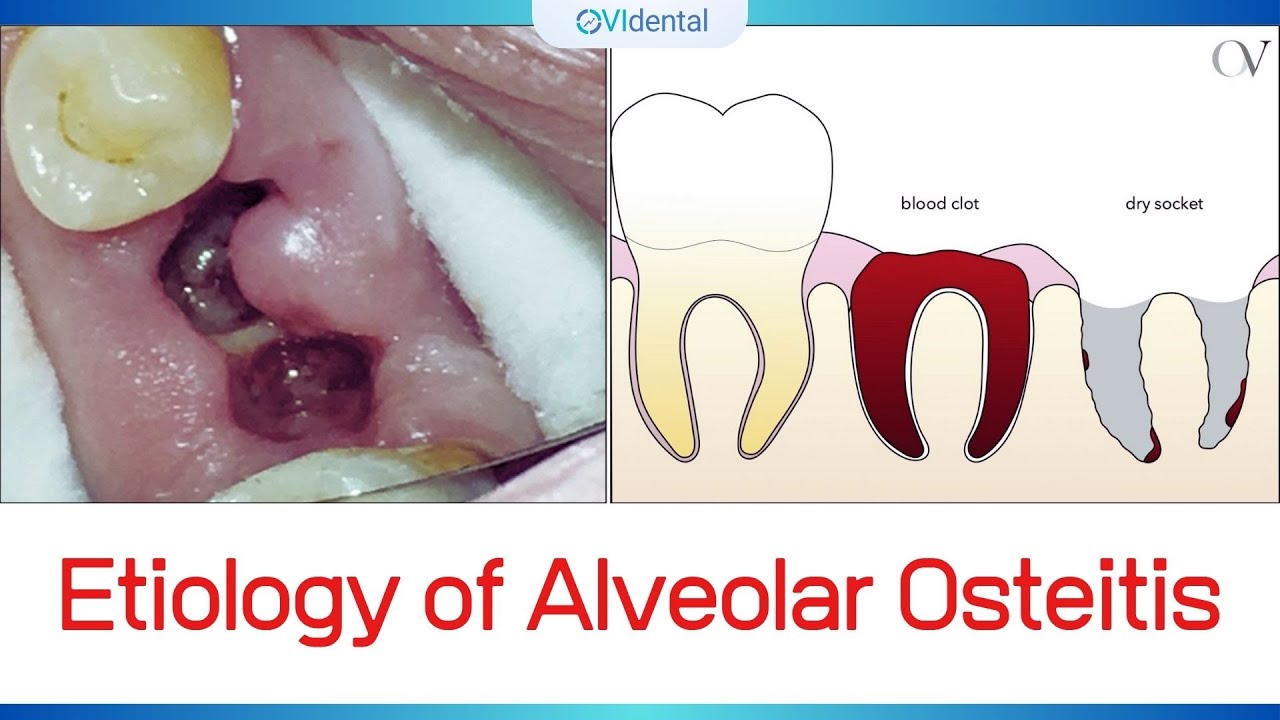 🚫 Etiology of Alveolar Osteitis (AO)
