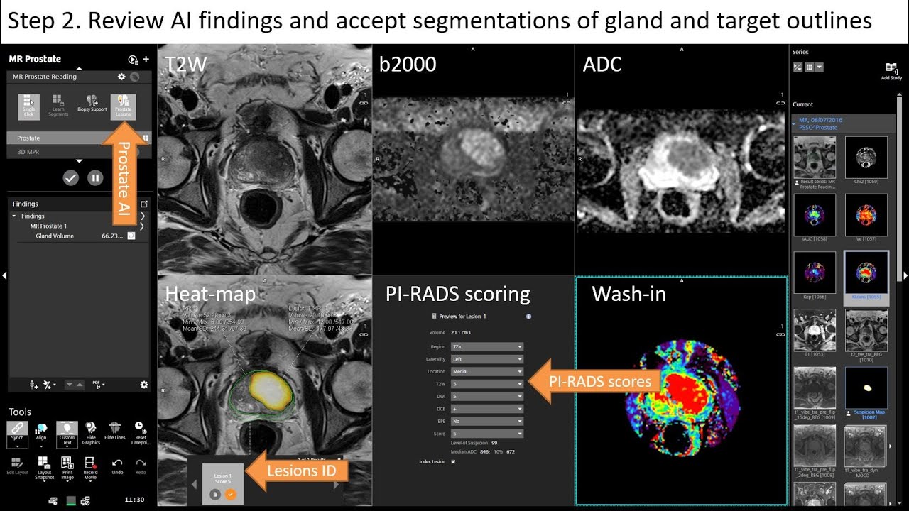 Artificial Intelligence software for Prostate Cancer Detection - case-based review