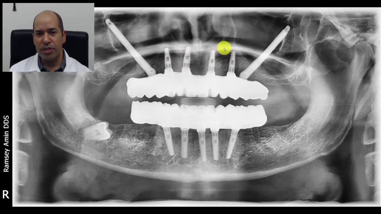 Long vs Short Dental Implants
