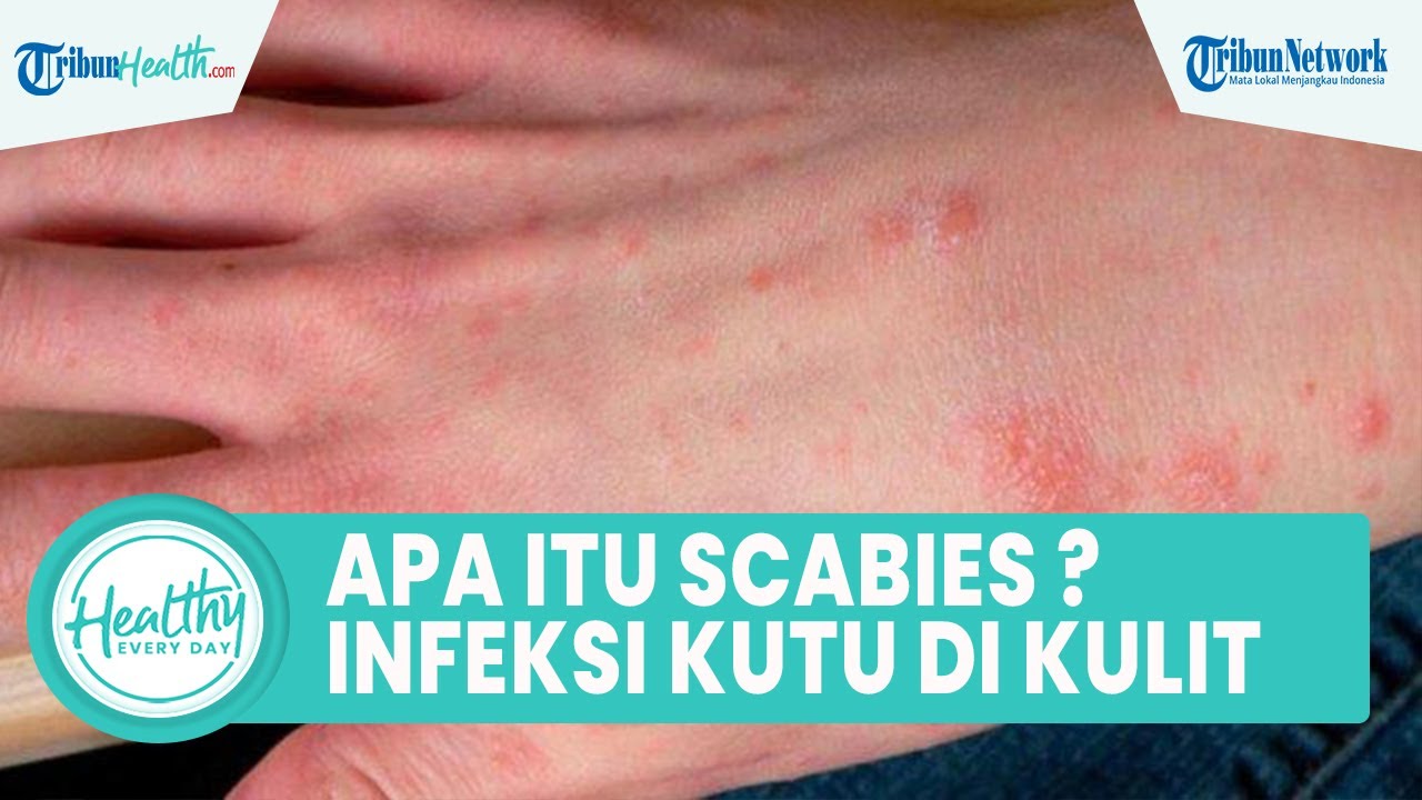 Apa itu Scabies? Faktor Risiko dan Cara Atasi Infeksi Kutu atau Parasit ...