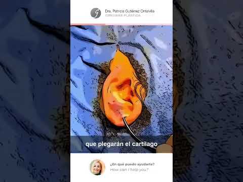 A Oscar (8 años) no le gusta la forma de sus orejas (Otoplastia) Dra. Patricia Gutiérrez Ontalvilla