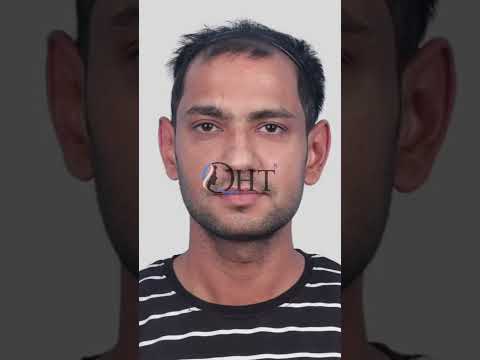 NW GRADE III A Patient’s 7 months result BY QHT REGROW CLINIC #hairtransplant #hair #haircare