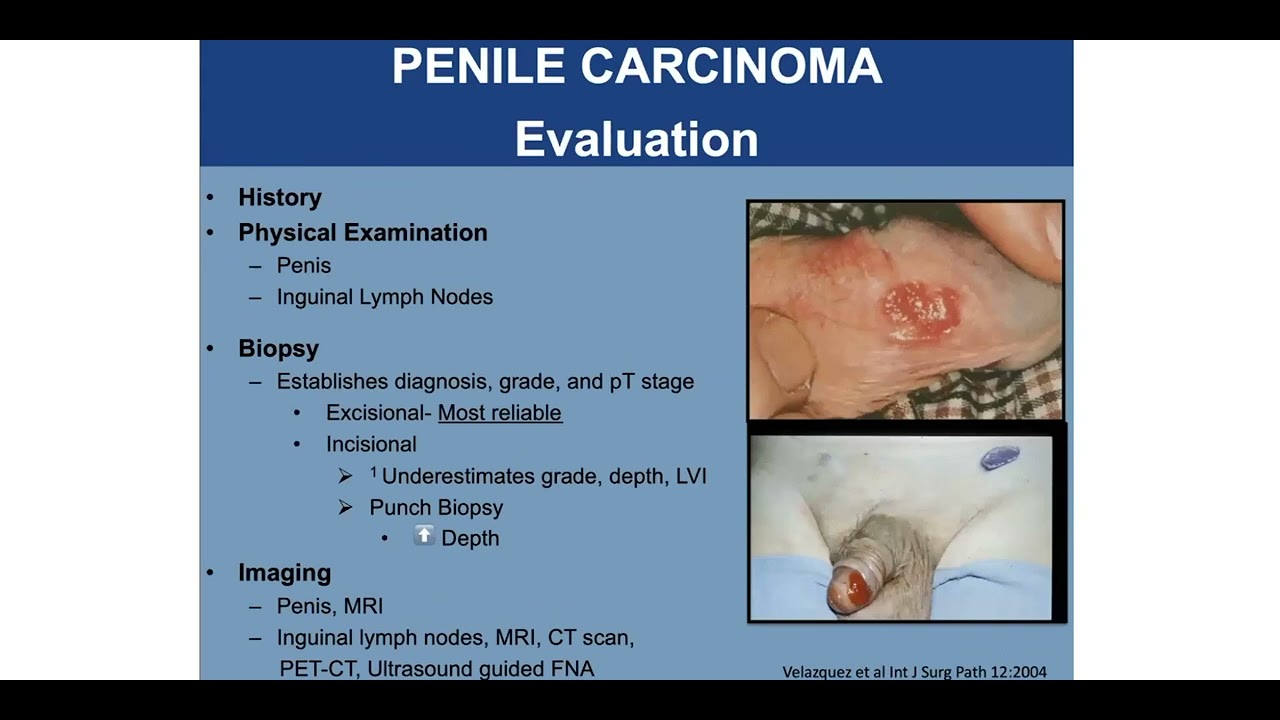 Penile Cancer Update 2022
