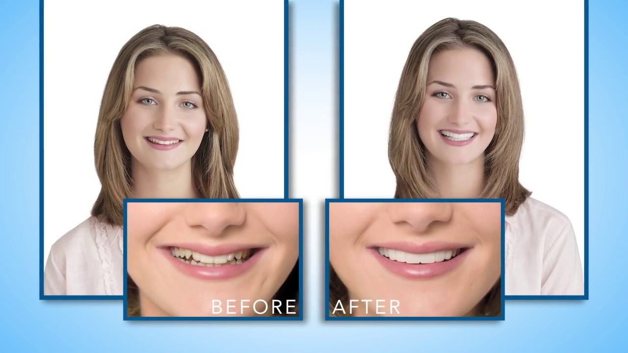 Introduction to the Snap-On Smile® Provisional Appliance