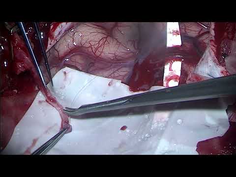 ICA occlusion: cerebral ischemia: EC-IC bypass