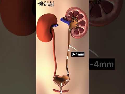 What size of kidney stone can easily pass | Treatment of Ureteric stones | How stone is removed