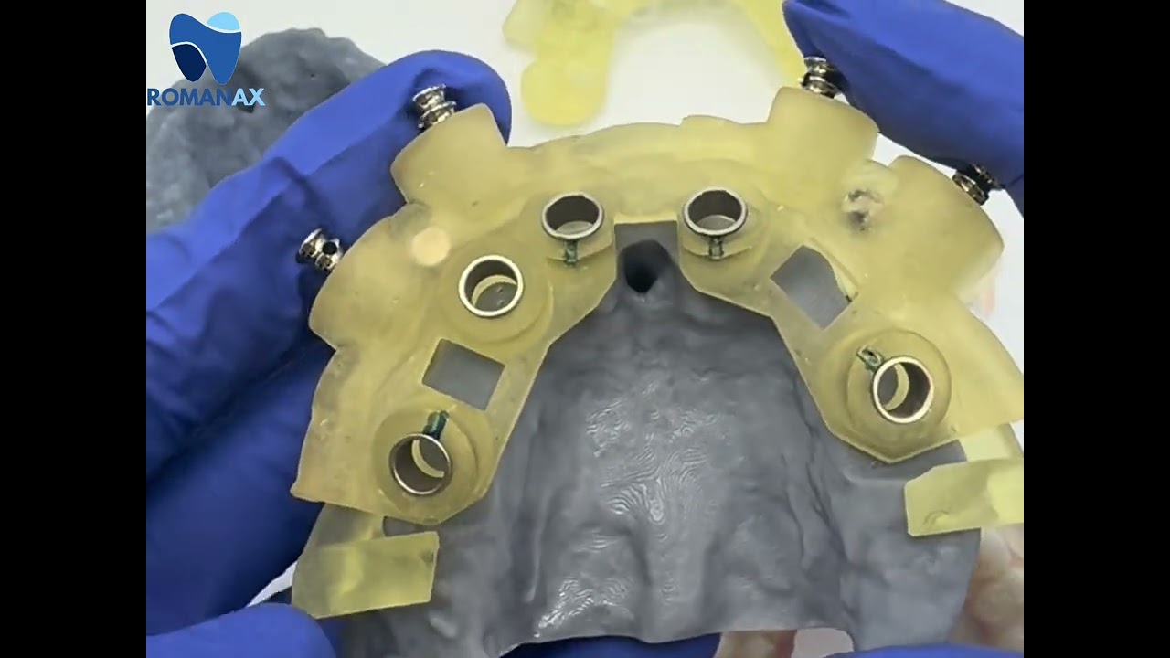 Explained: Dental Implants 🦷 All on x Surgical Guides