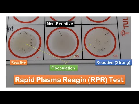 RPR test for Syphilis Strong Positive Observation