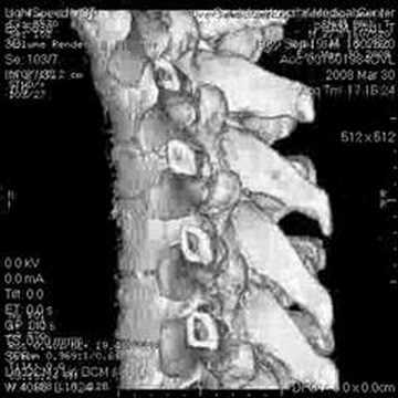 CT scan of my spine