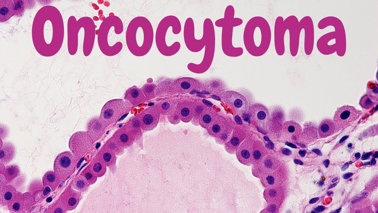 Renal Oncocytoma - Pathology mini tutorial