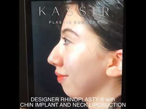 Designer Rhinoplasty/ Chin Implant and Liposuction of the neck by Dr. Kassir