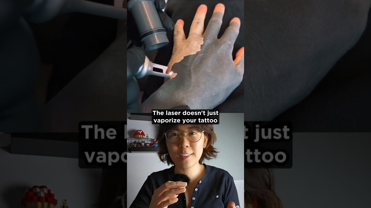 Where Does Your Tattoo Ink Go? The Science Behind Laser Removal