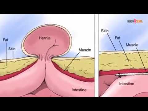 Bahaya hernia/turun berok