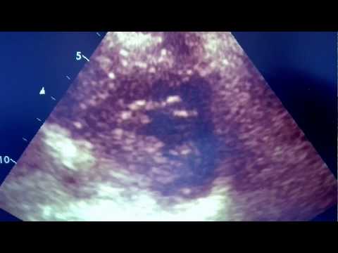 Cardiac rhabdomyoma in tuberus sclerosis