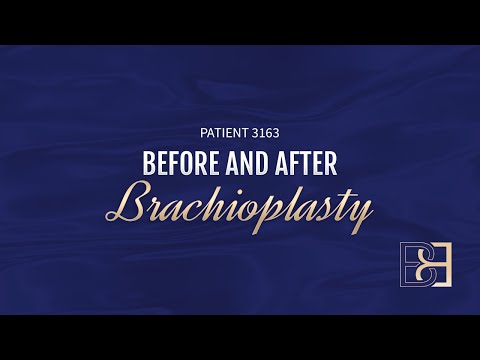 Brachioplasty (Arm Lift) Post Weight Loss {Patient 3163} Before & After