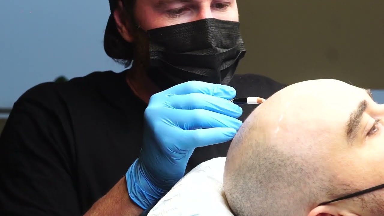 Scalp Micropigmentation by INK BARBER.