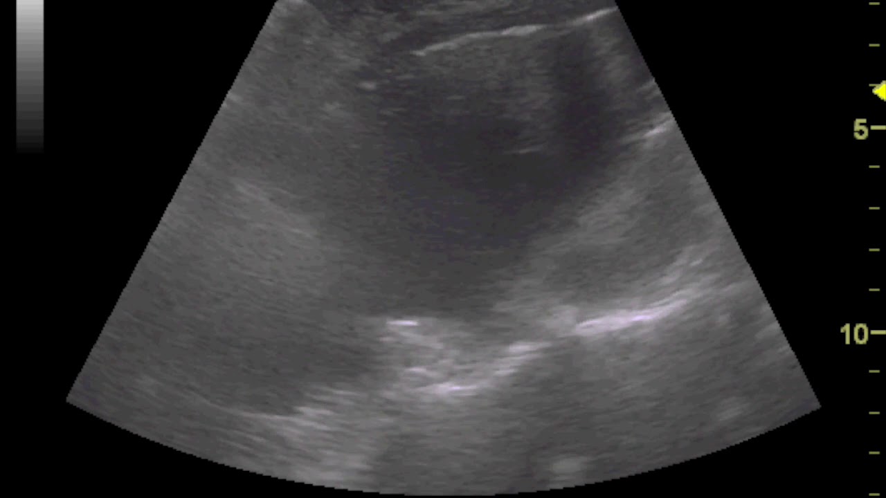 Retroperitoneal haemorrhage