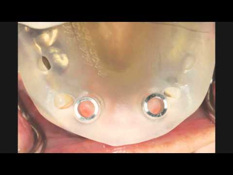 Dr. Timothy Kosinski - Restorative Driven Impant Solutions Utilizing the Latest Technology