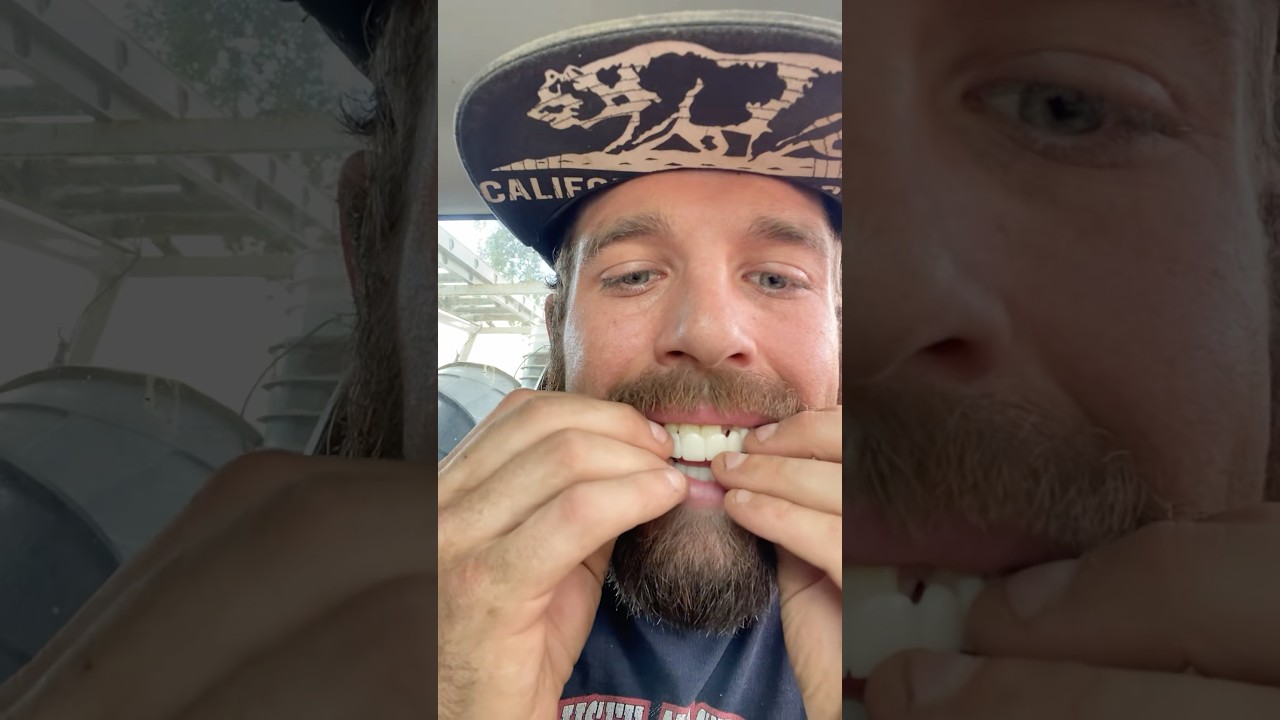 These Snap On Veneers Actually Look GOOD?! 😮🦷 #teeth #veneers #dentist