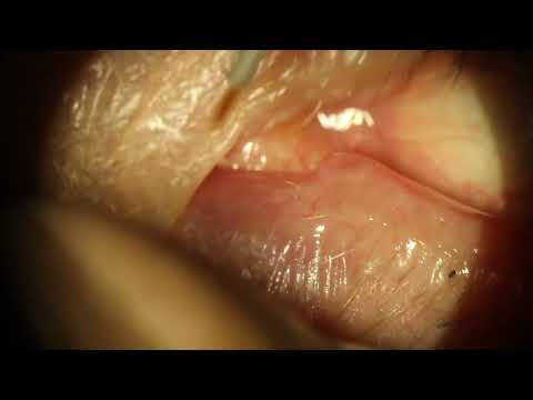 Inserting Oasis Hydrogel Punctal Plug