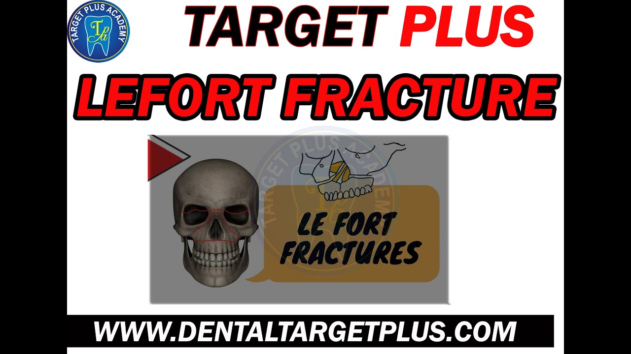 LEFORT FRACTURE MCQS| TARGET PLUS ACADEMY
