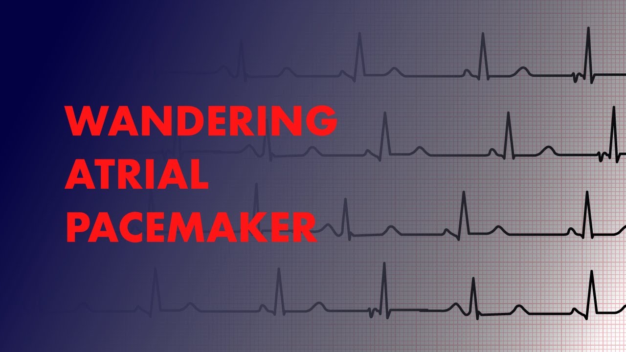 Wandering Atrial Pacemaker -  EKG (ECG) Interpretation