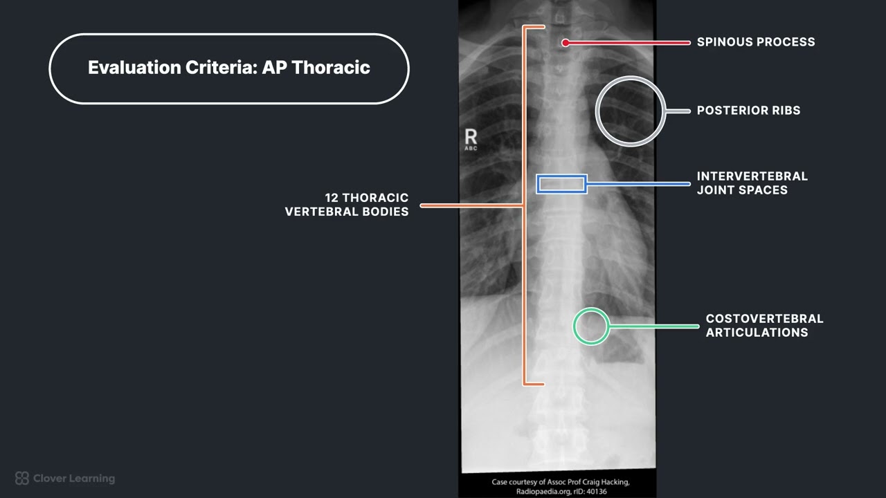How to Recognize Key Anatomy on Radiographs of the Thoracic Spine