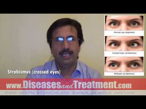 Strabismus (crossed eyes) : Causes, Symptoms, Diagnosis, Treatment, Prevention