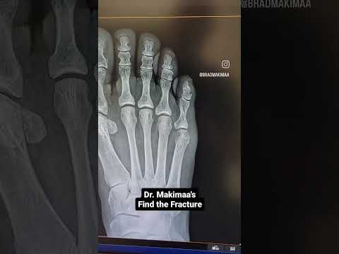 Find the fracture - fifth proximal phalanx fracture