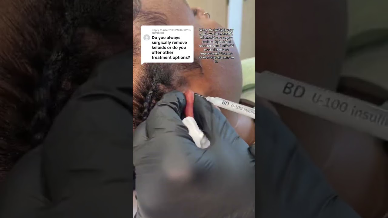 No, we don’t always surgically remove keloids #keloid #keloidremoval #keloidinjection