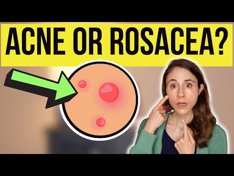 IS IT ACNE OR ROSACEA? 😳 Dermatologist @DrDrayzday