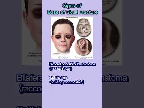 signs of base of skull fracture. battle'sign,racoon eye sign, CSF rhinorrhea #medico #inicet #image