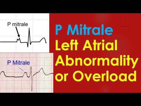 P Mitrale – Left Atrial Abnormality  or Overload