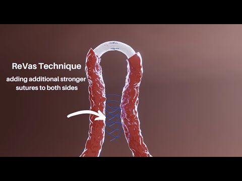Vasectomy Reversal: REinforcing VAsal Suture (ReVas Technique)