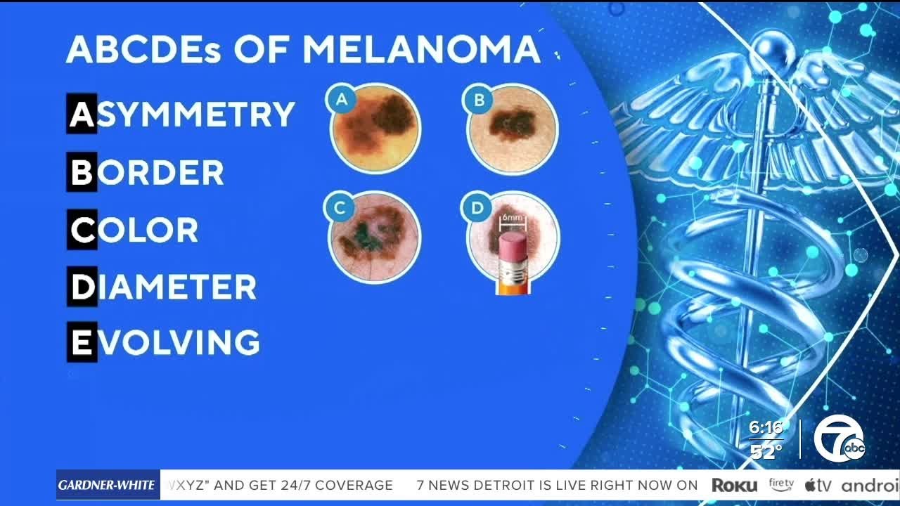 Signs to look out for with melanoma during Skin Cancer Awareness Month